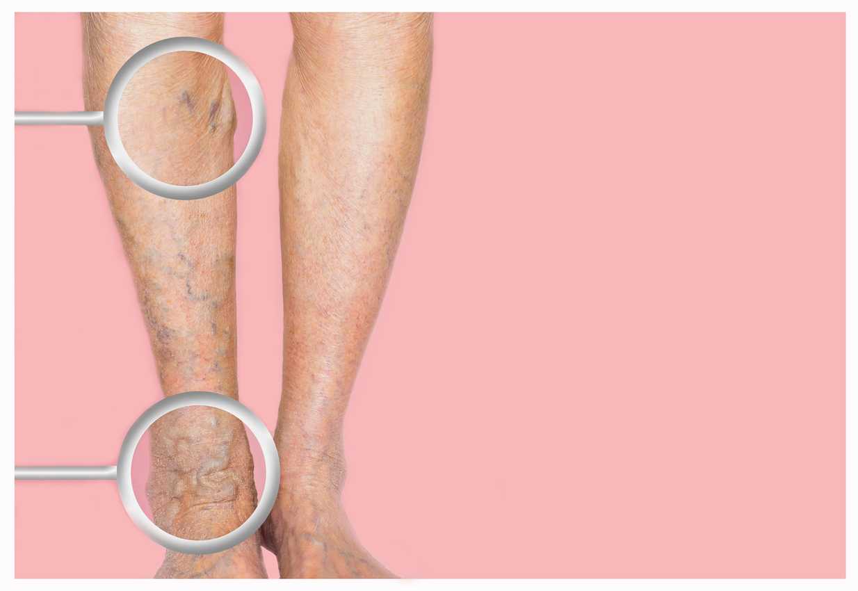 Varis Nedir, Belirtileri Neler, Tedavisi - Sağlık Rehberi