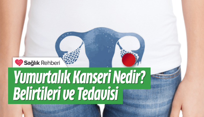 Over ( Yumurtalık) Kanseri Nedir? Belirtileri ve Tedavisi - Sağlık Rehberi